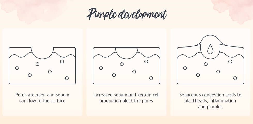 Pimples on the back - causes and treatment | parfumdreams
